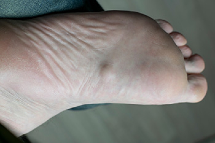 What Is the Bump on the Bottom of My Foot?