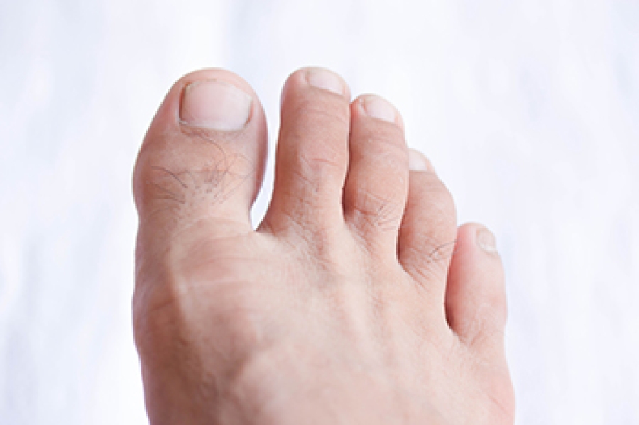 Causes of Loose Toenails